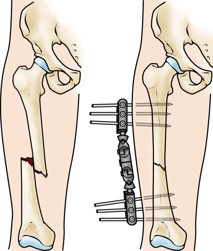 Minimally Invasive Surgeries & Fracture Fixation - Best Hospitals in ...